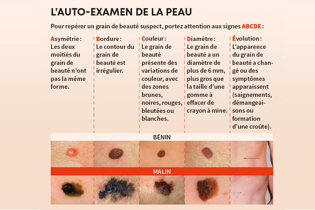 Prévention et dépistage du cancer de la peau : en fait-on assez ...
